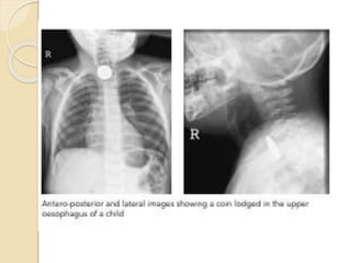 foreign body radiography.pptx