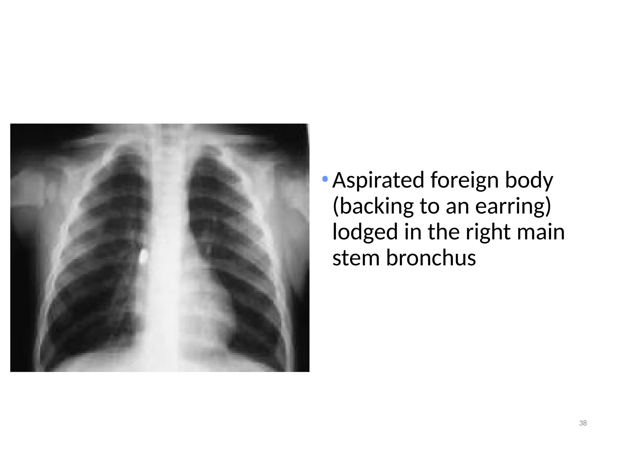 FOREIGN BODY RADIOGRAPHY MEDICAL IMAGING.ppt