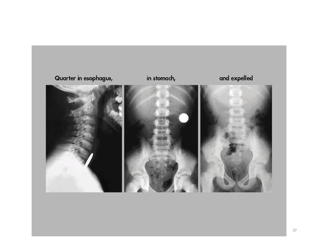 FOREIGN BODY RADIOGRAPHY MEDICAL IMAGING.ppt