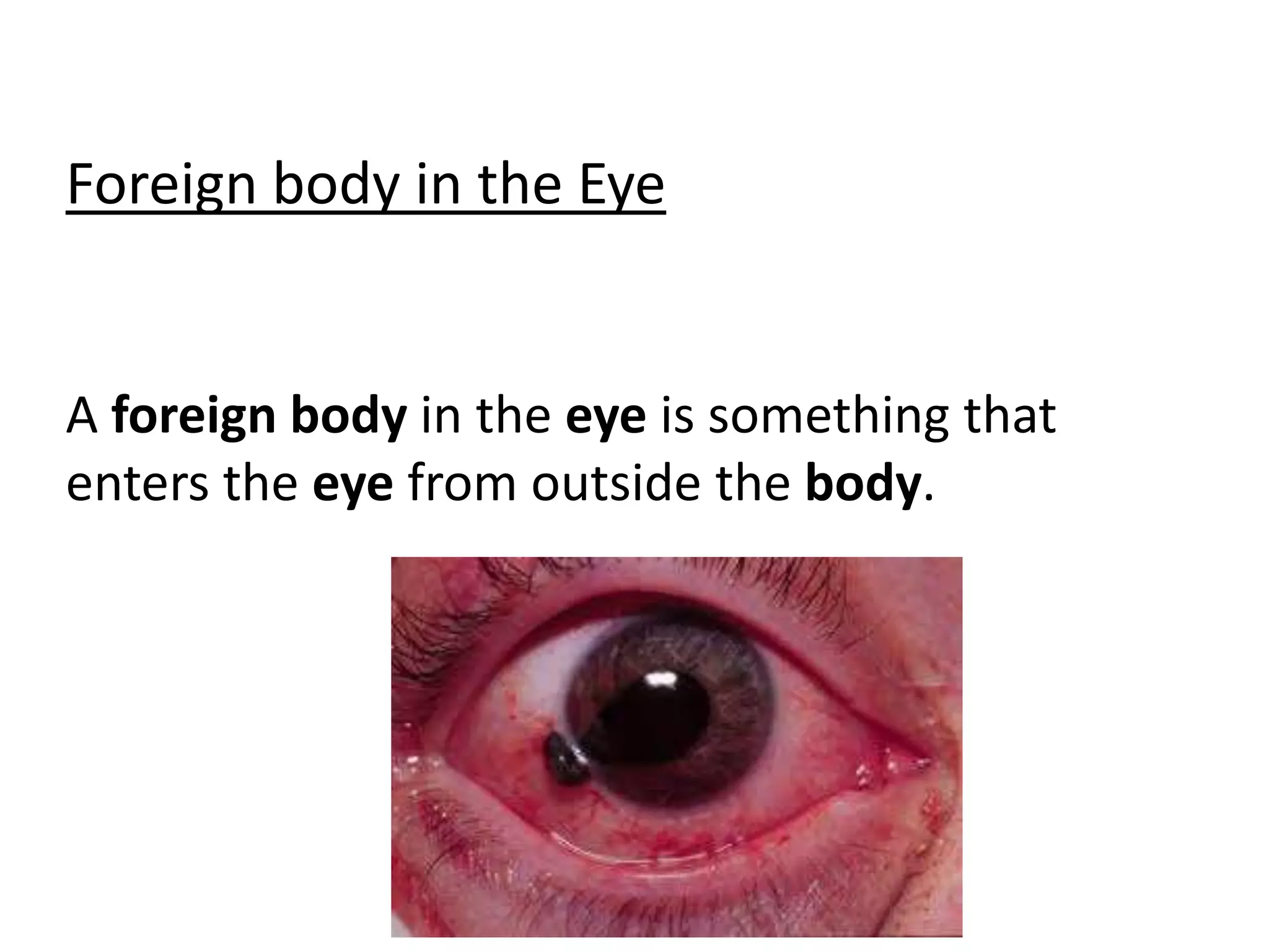 Foreign body & trauma to the eye | PPTX