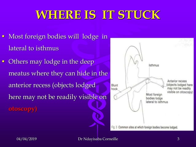 Forein body in the ear and the nose management | PPTX