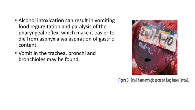 Forensic aspects of alcohol | PPTX
