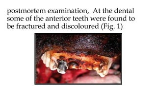 Forensic dentistry | PPTX
