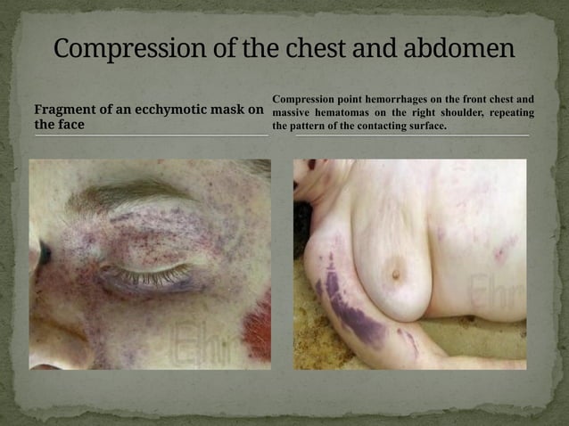 FORENSIC MEDICAL EXAMINATION OF MECHANICAL ASPHYXIA.pptx