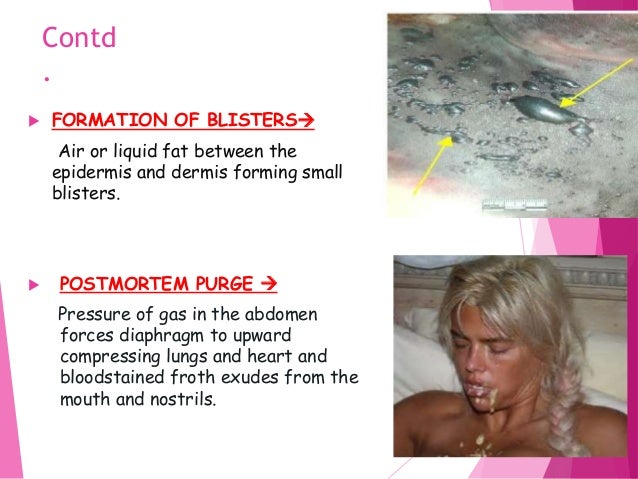 Forensic medicene,putrefaction