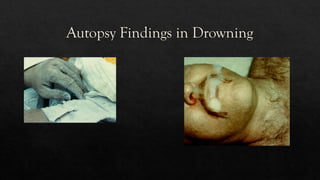 Differential diagnosis between Drowning Vs Retention of cadaver in ...