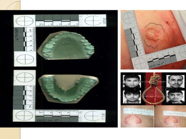 FORENSIC ODONTOLOGY CASE IN INDIA.pptx.. | PPTX