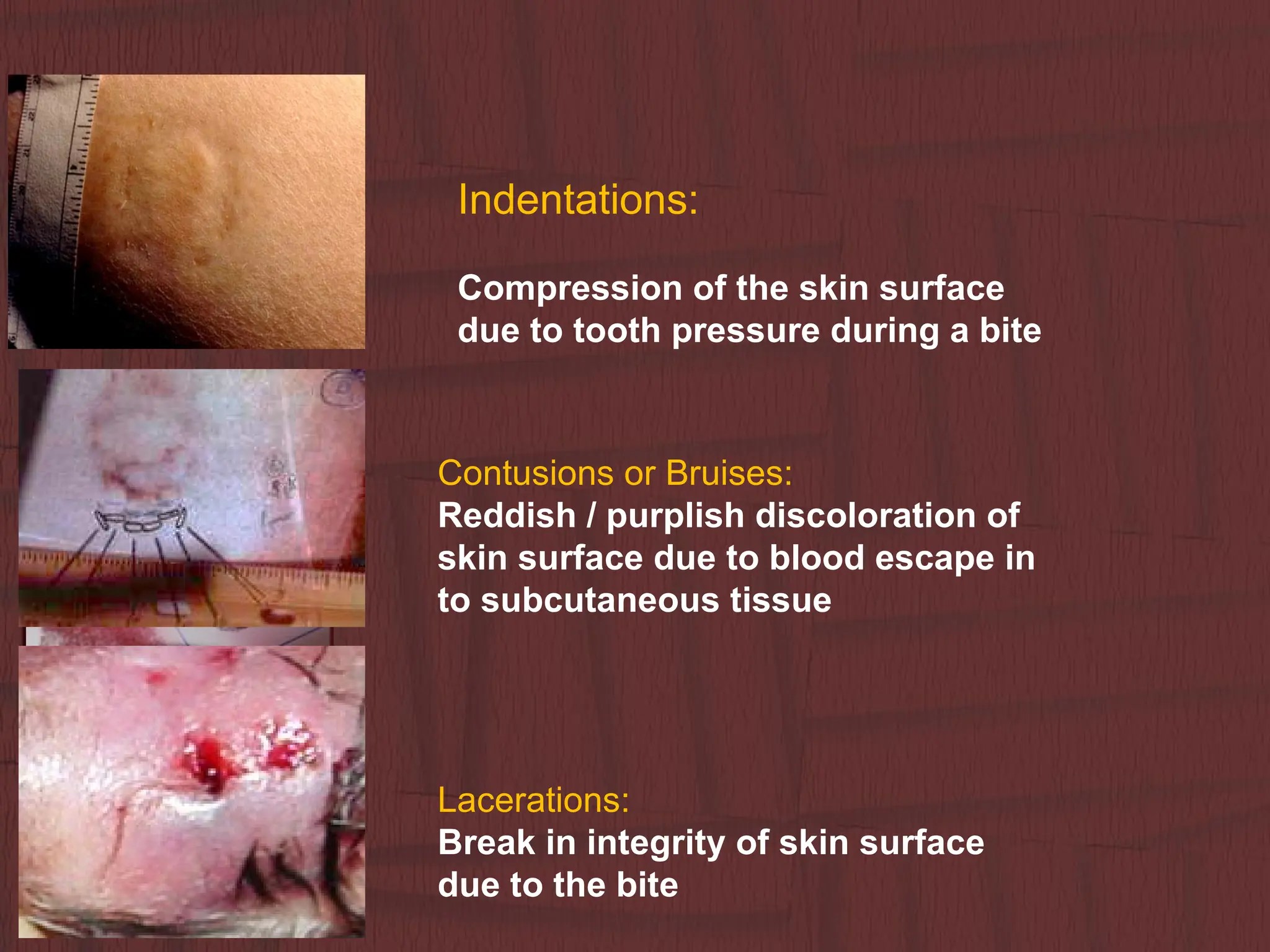INTRODUCTION TO FORENSIC ODONTOLOGY PART II | PPTX