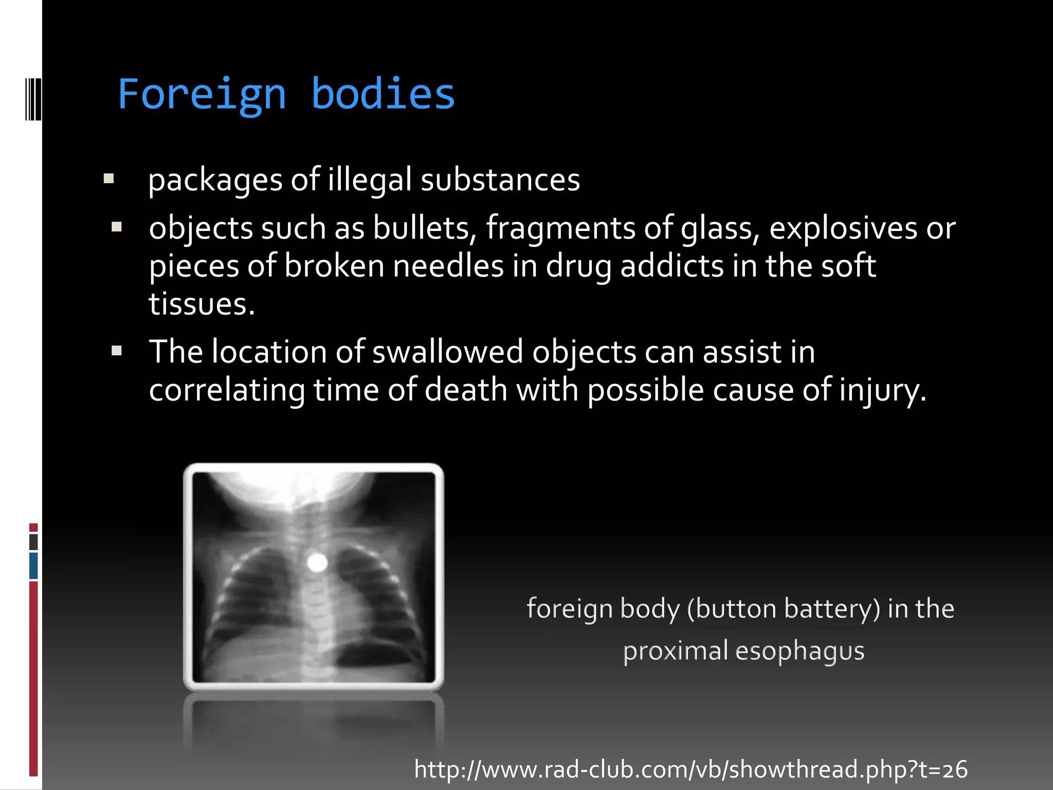 Forensic Radiography | PPTX