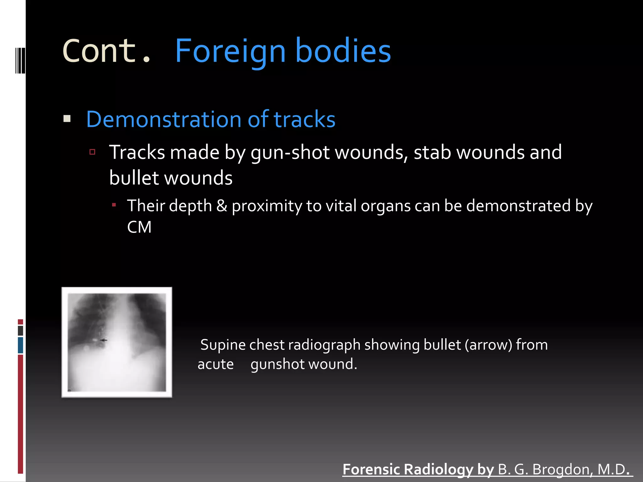 Forensic Radiography | PPTX