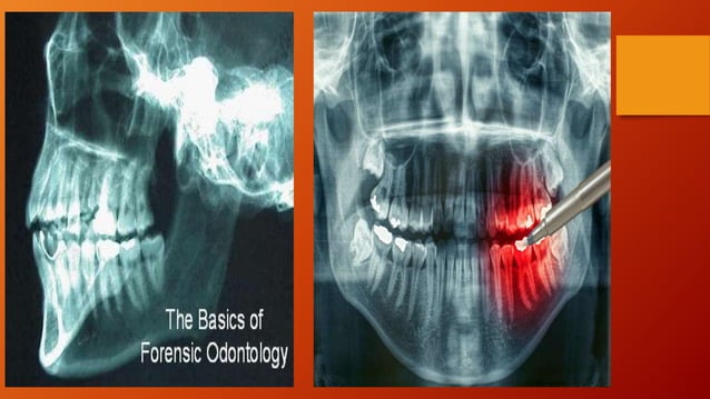 Forensic radiography | PPTX | Dental Health | Diseases and Conditions