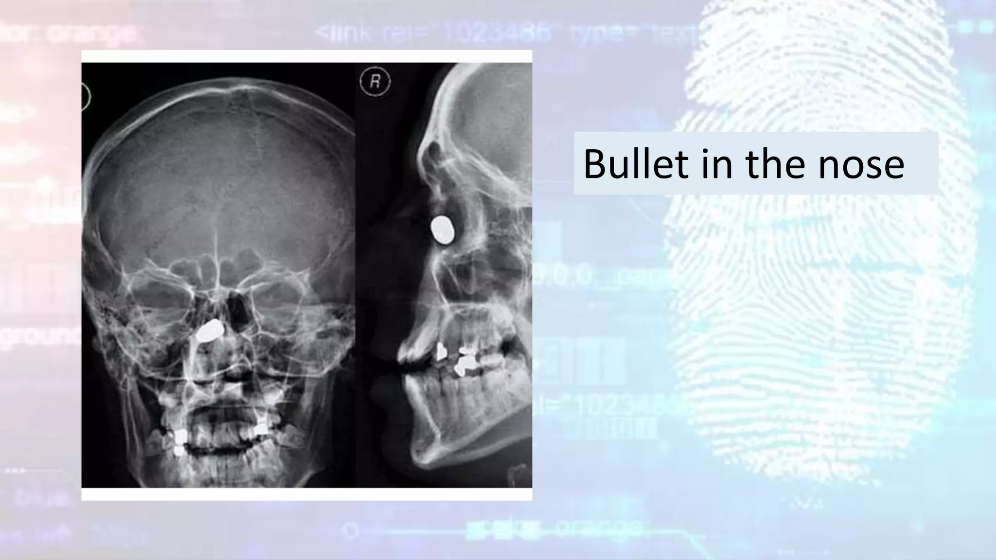 Forensic Radiology | PPTX