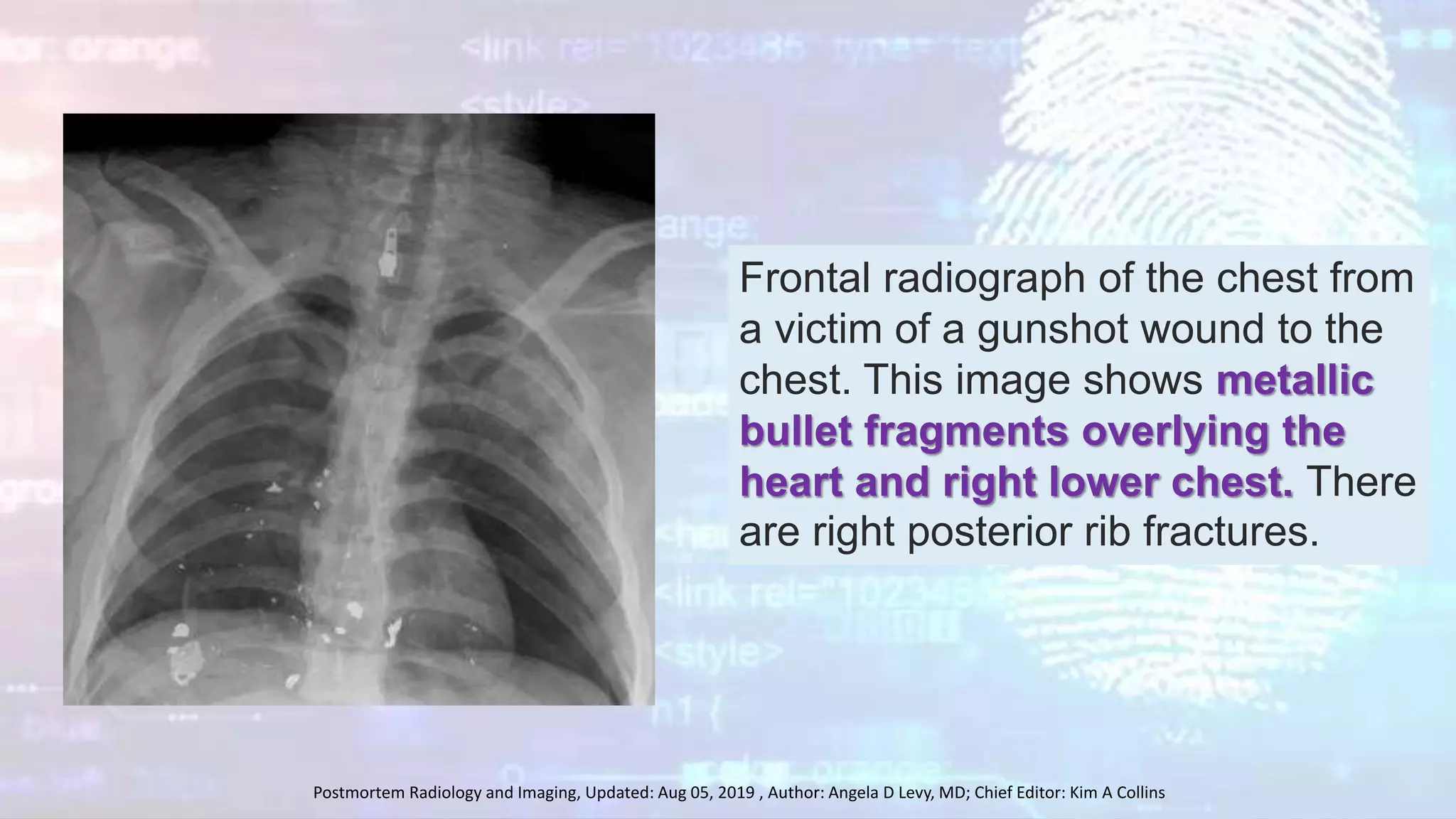 Forensic Radiology | PPTX