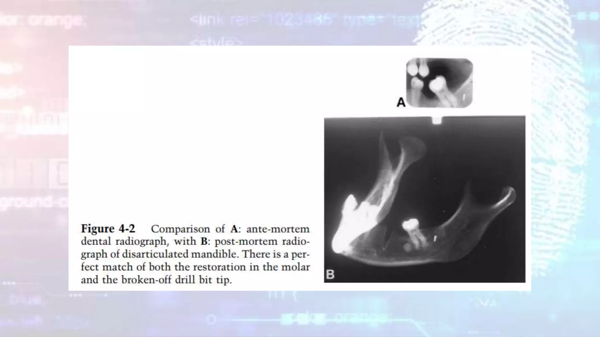 Forensic Radiology | PPTX