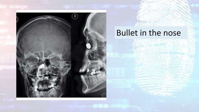 Forensic Radiology | PPTX