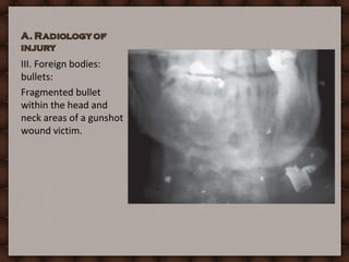 Forensic radiology practical under | PPT | Death, Injury, or Military ...
