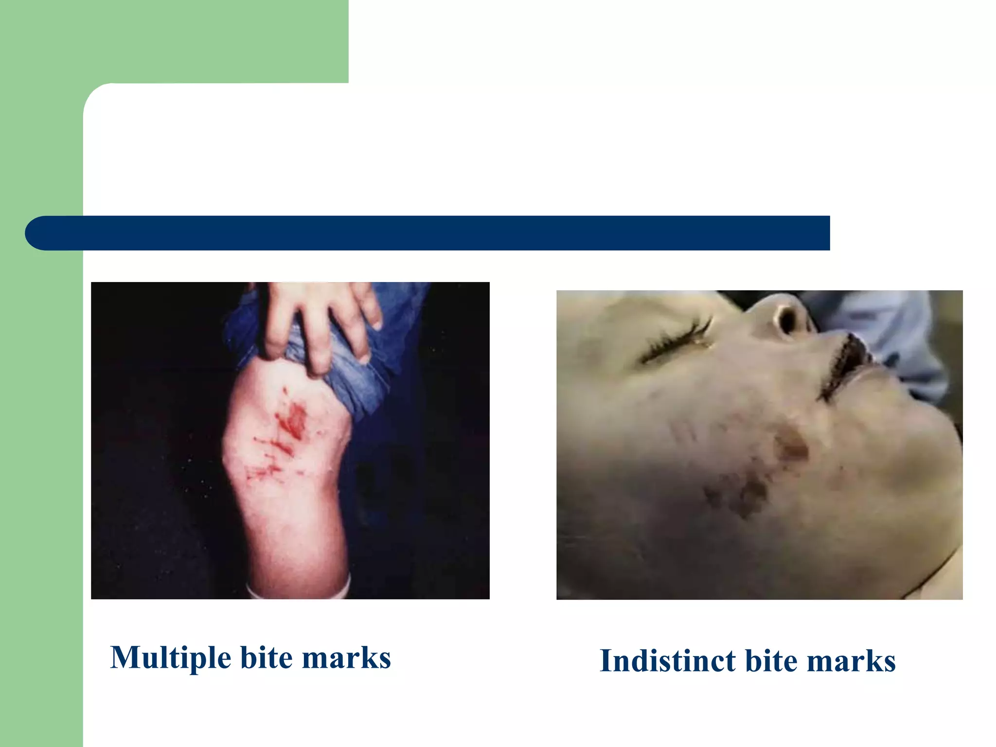 Forensic science bite marks | PPT