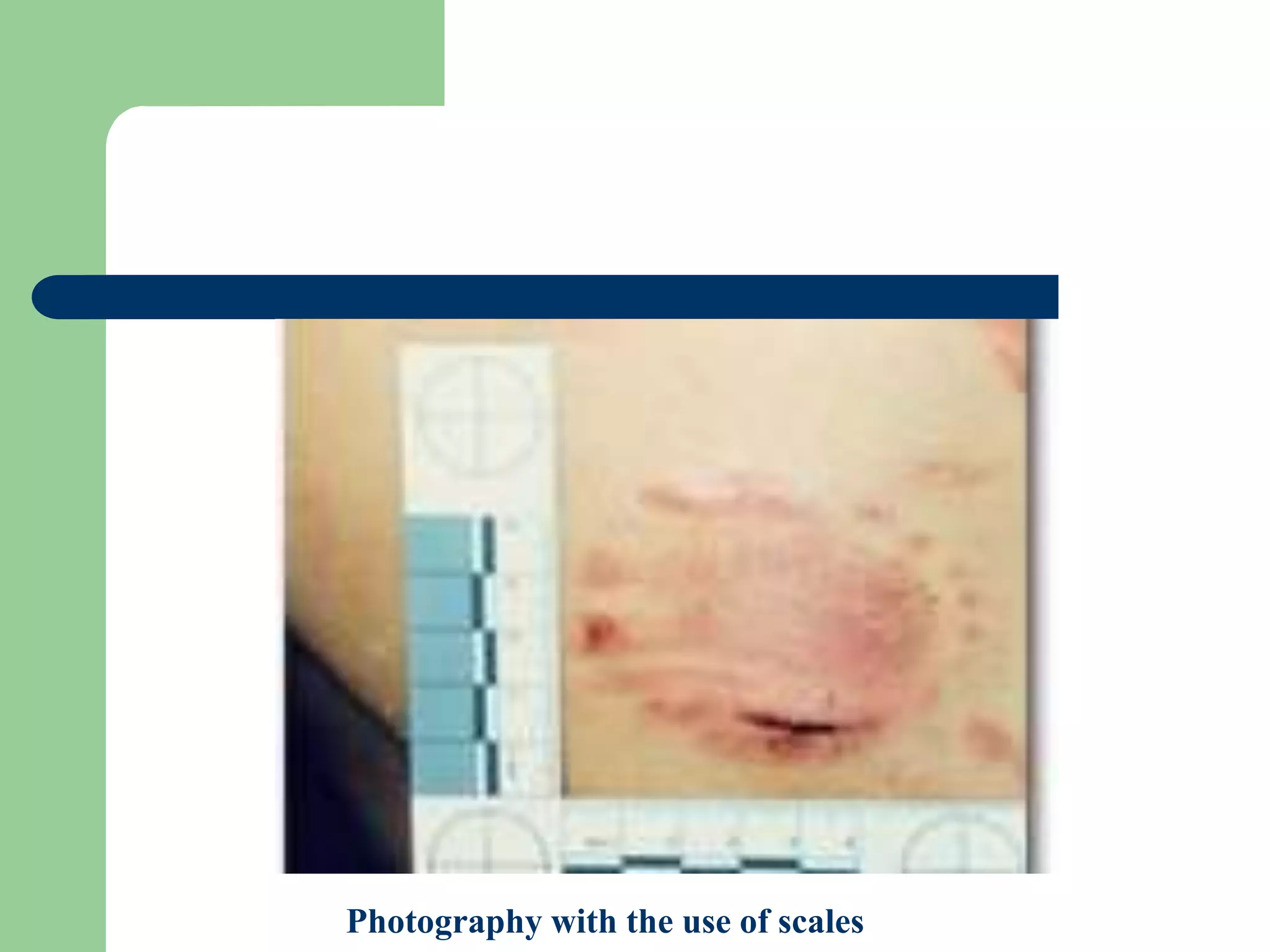 Forensic science bite marks | PPT