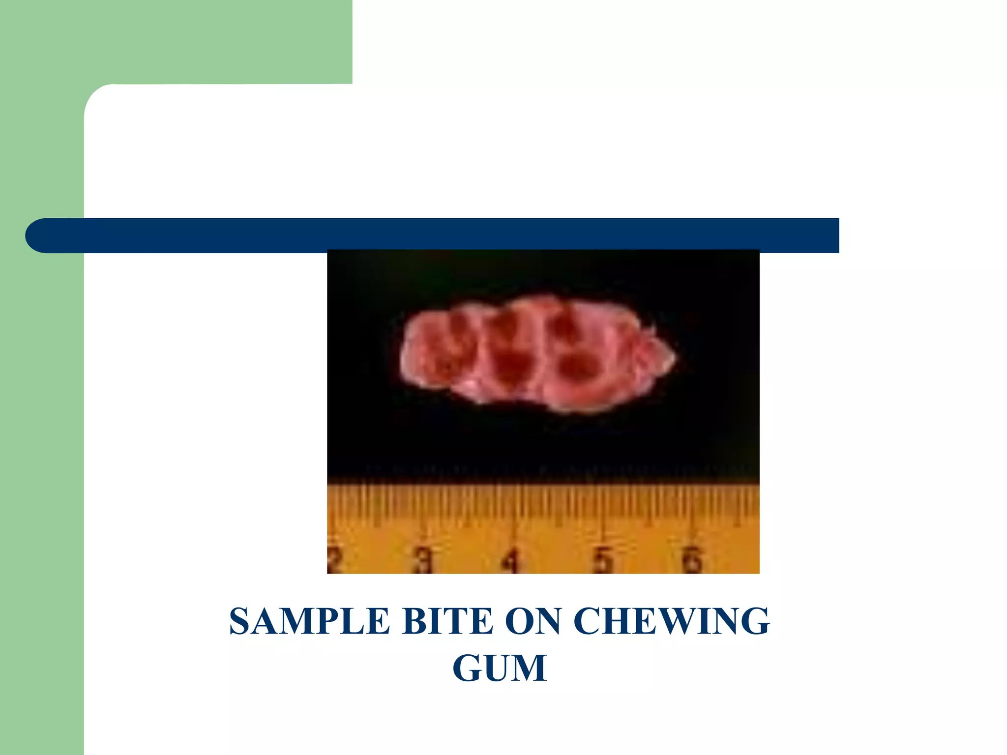 Forensic science bite marks | PPT