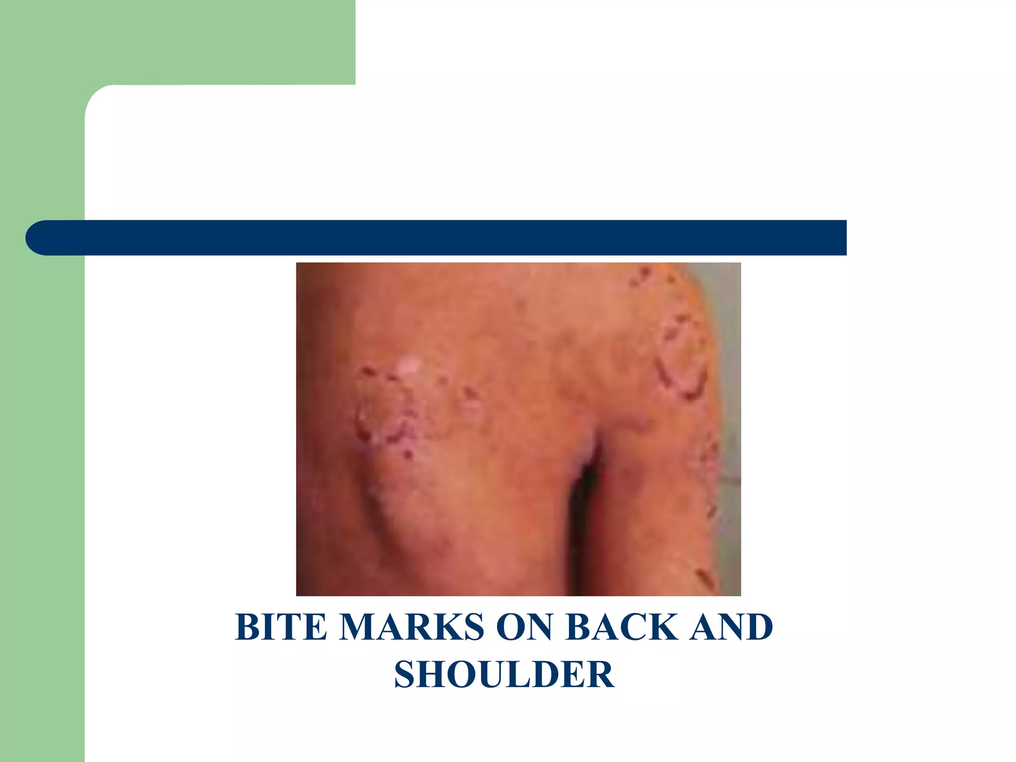 Forensic science bite marks | PPT