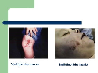 Forensic science bite marks | PPT