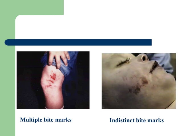 Forensic science bite marks | PPT | Dental Health | Diseases and Conditions