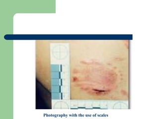 Forensic science bite marks | PPT