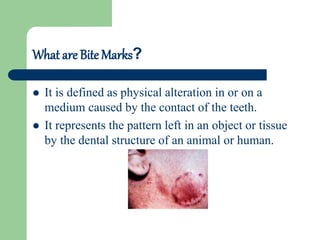 Forensic science bite marks | PPT