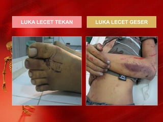 Forensik Traumatologi Forensik Traumatologi | PPTX