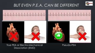 Forget ACLS Guidelines when dealing with PEA. Part1. | PPT
