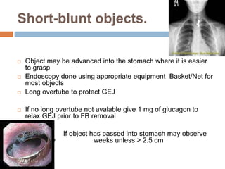 Foriegn body upper GI tract -role of endoscopy. | PPTX