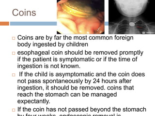 Foriegn body upper GI tract -role of endoscopy. | PPTX