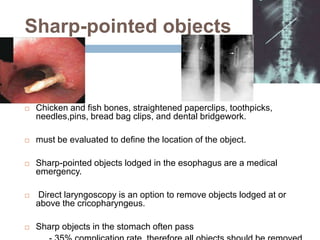 Foriegn body upper GI tract -role of endoscopy. | PPTX