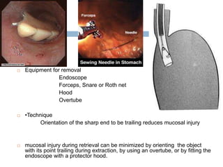 Foriegn body upper GI tract -role of endoscopy. | PPTX