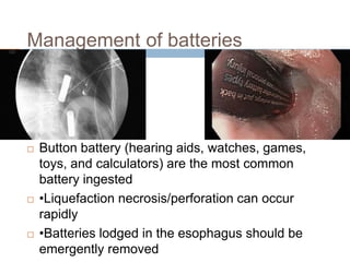 Foriegn body upper GI tract -role of endoscopy. | PPTX