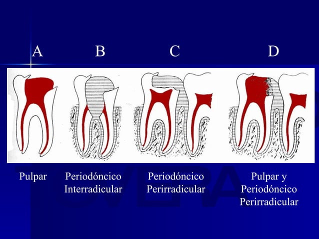 Diagnóstico pulpar y periapical