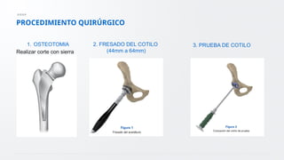 FORMACIÓN ARTROPLASTIA ENFERMERÍA CADERA MM.pptx