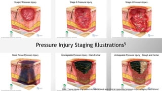 Formal Case Study: Pressure Ulcers | PPTX