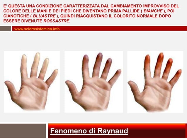 Format fenomeno di raynaud | PPTX | Diseases and Conditions | Medical ...