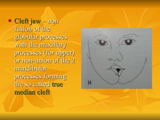 Formation of the palate | PPT