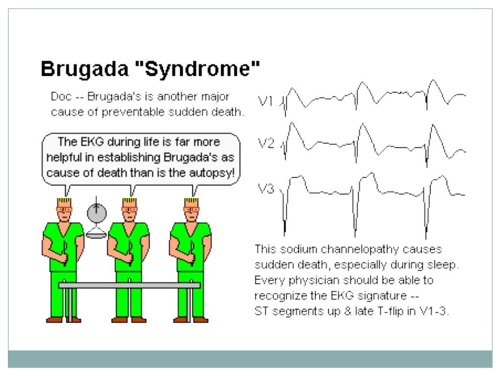 Brugada syndrome