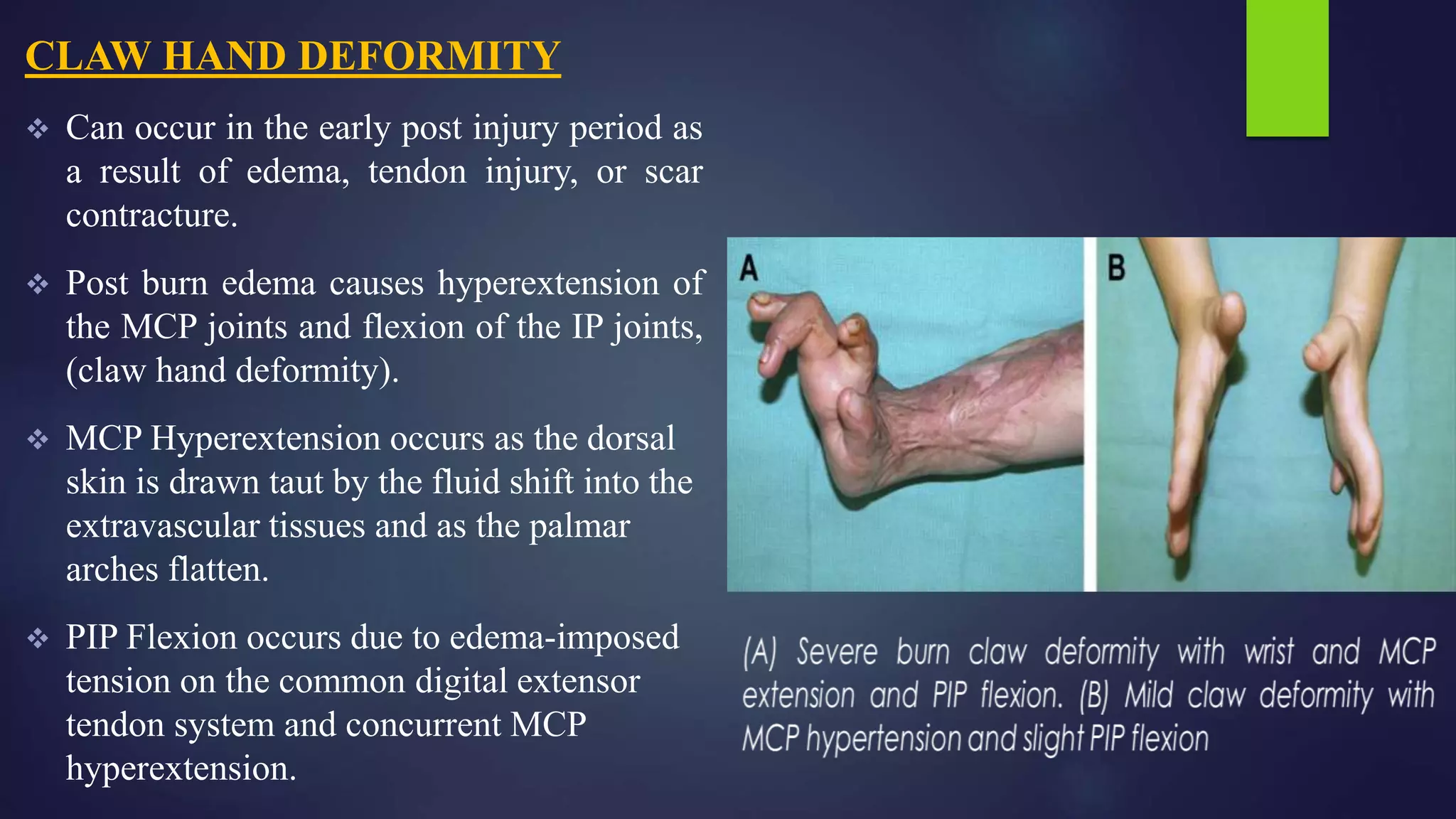 Hand Rehabilitation In Burns | PPTX