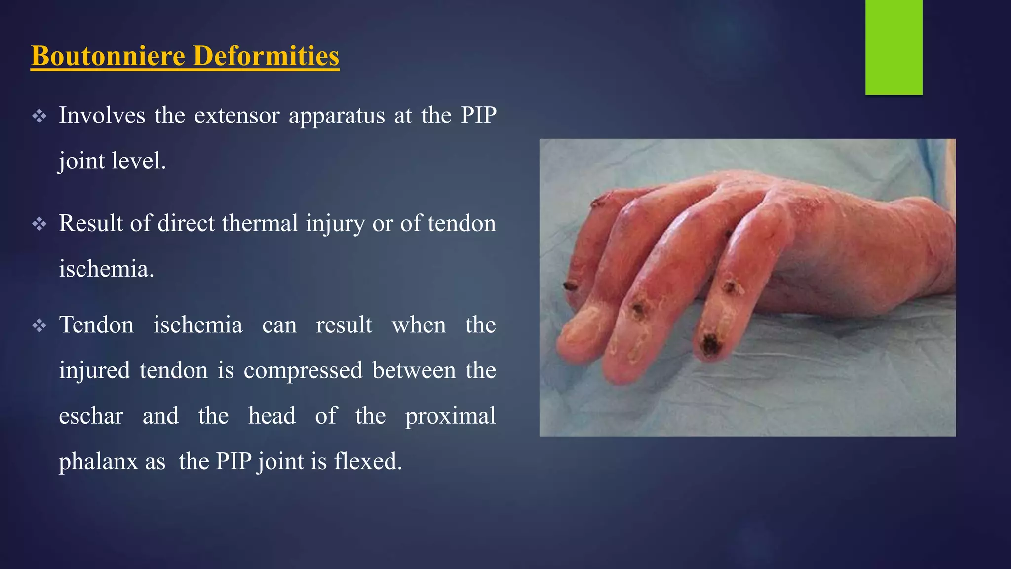 Hand Rehabilitation In Burns | PPTX