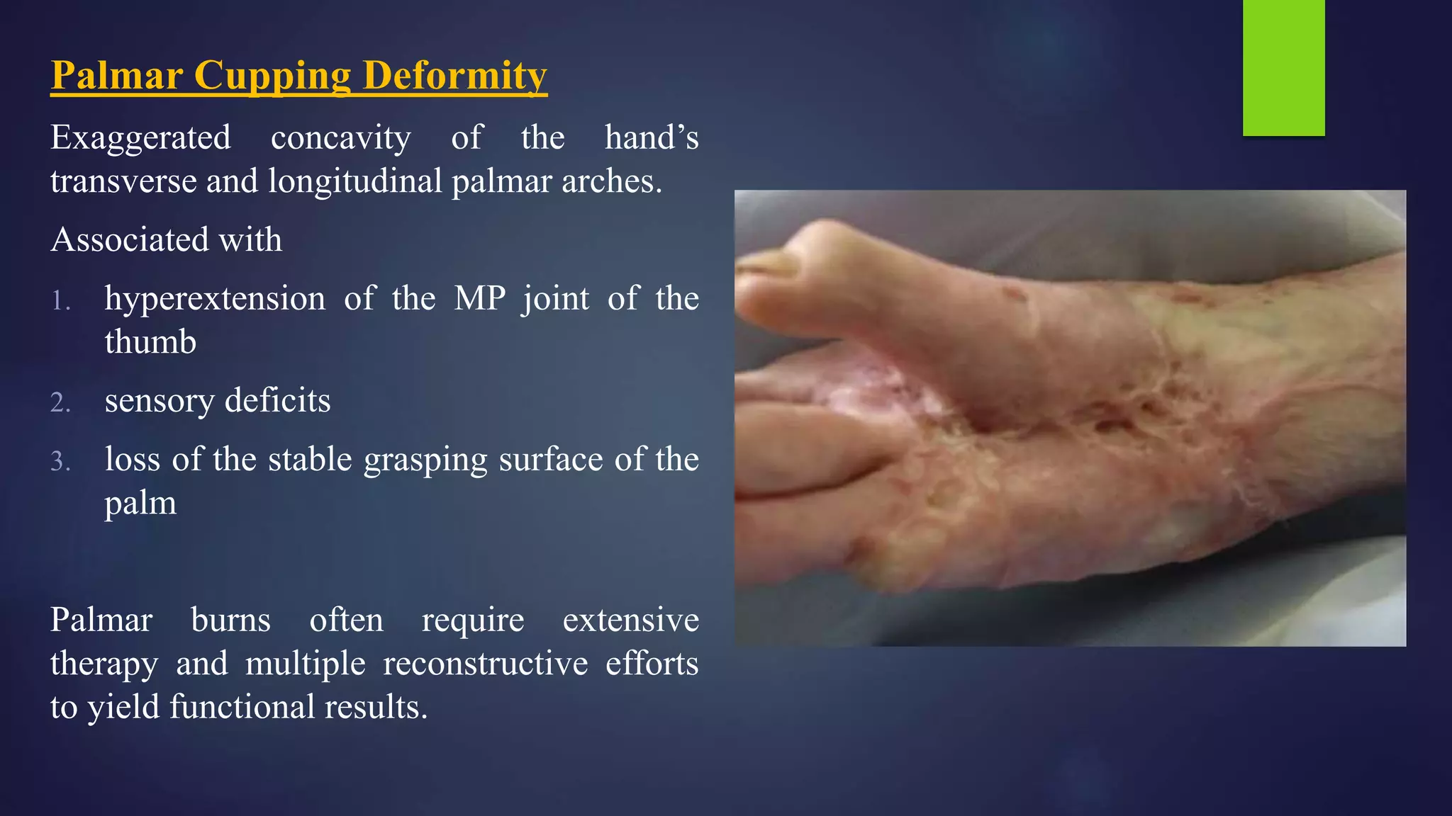 Hand Rehabilitation In Burns | PPTX