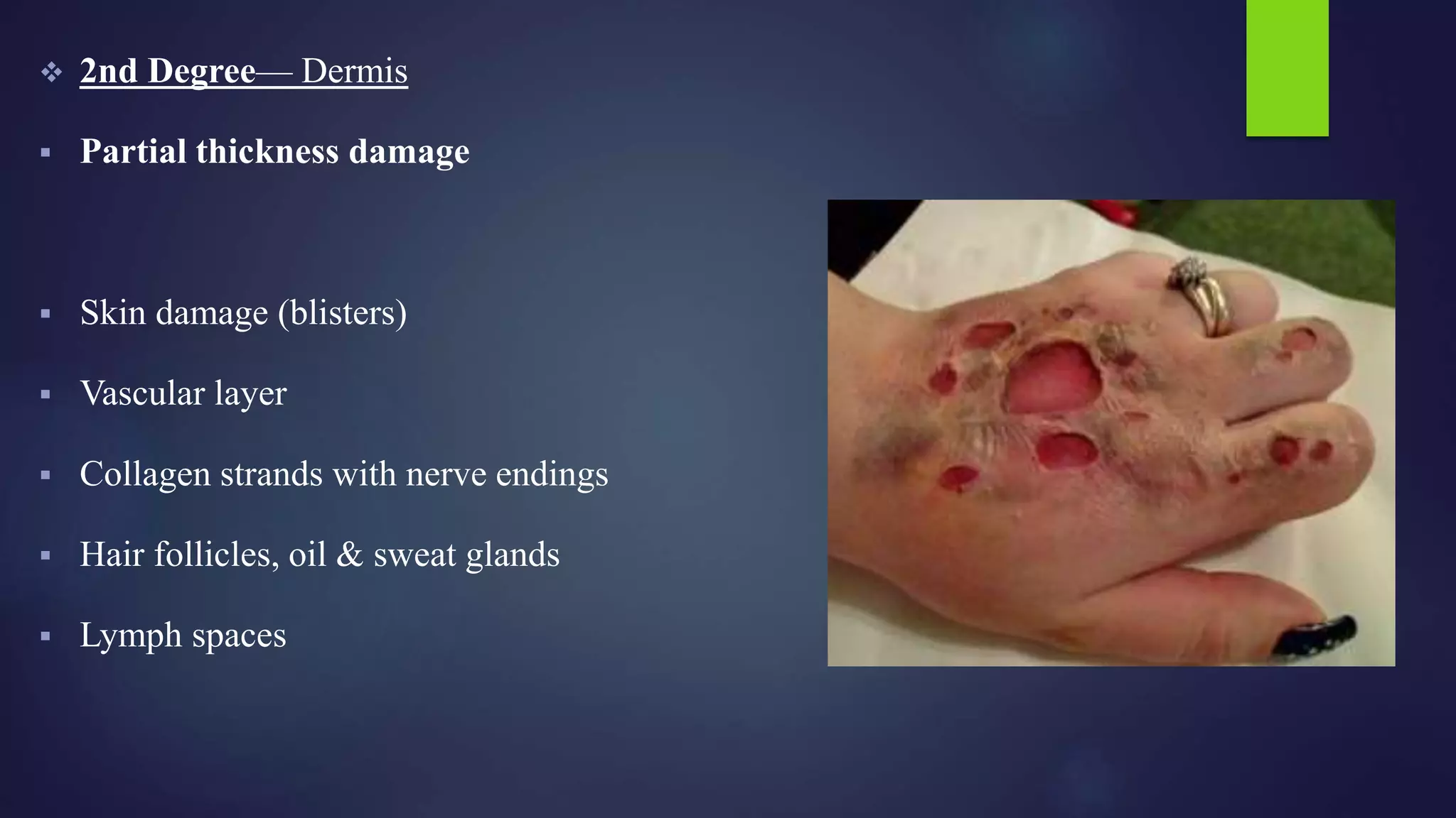 Hand Rehabilitation In Burns | PPTX