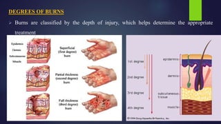 Hand Rehabilitation In Burns | PPTX