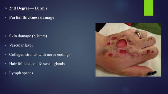 Hand Rehabilitation In Burns | PPT