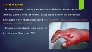 Hand Rehabilitation In Burns | PPT