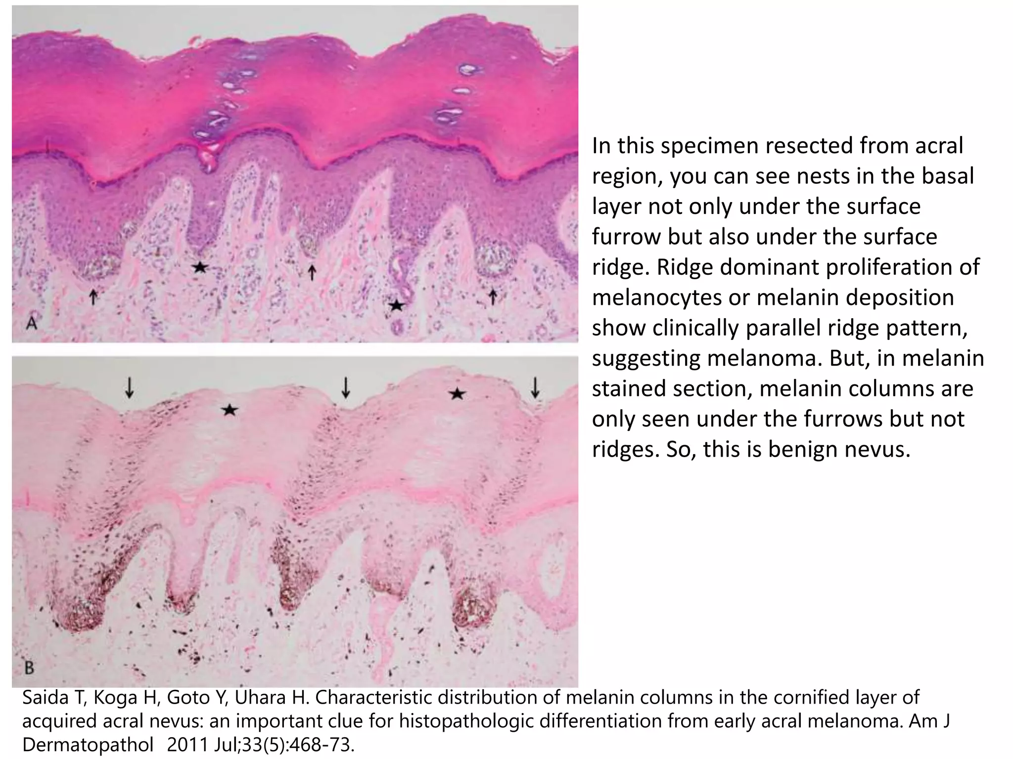 Pathological evaluation of melanocytic lesions | PPTX