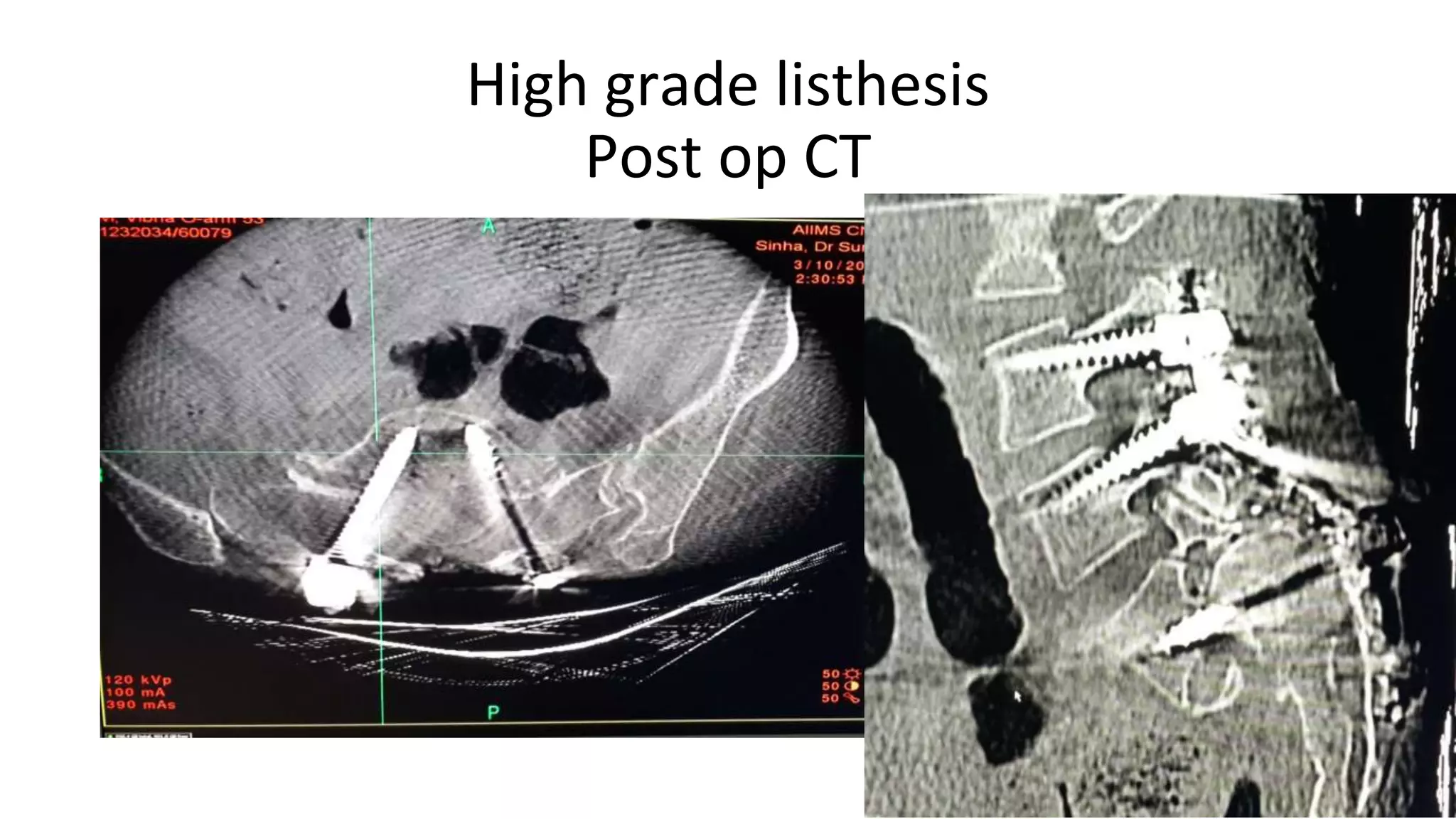 Fortis lecture High Grade Spondylolisthesis | PPTX